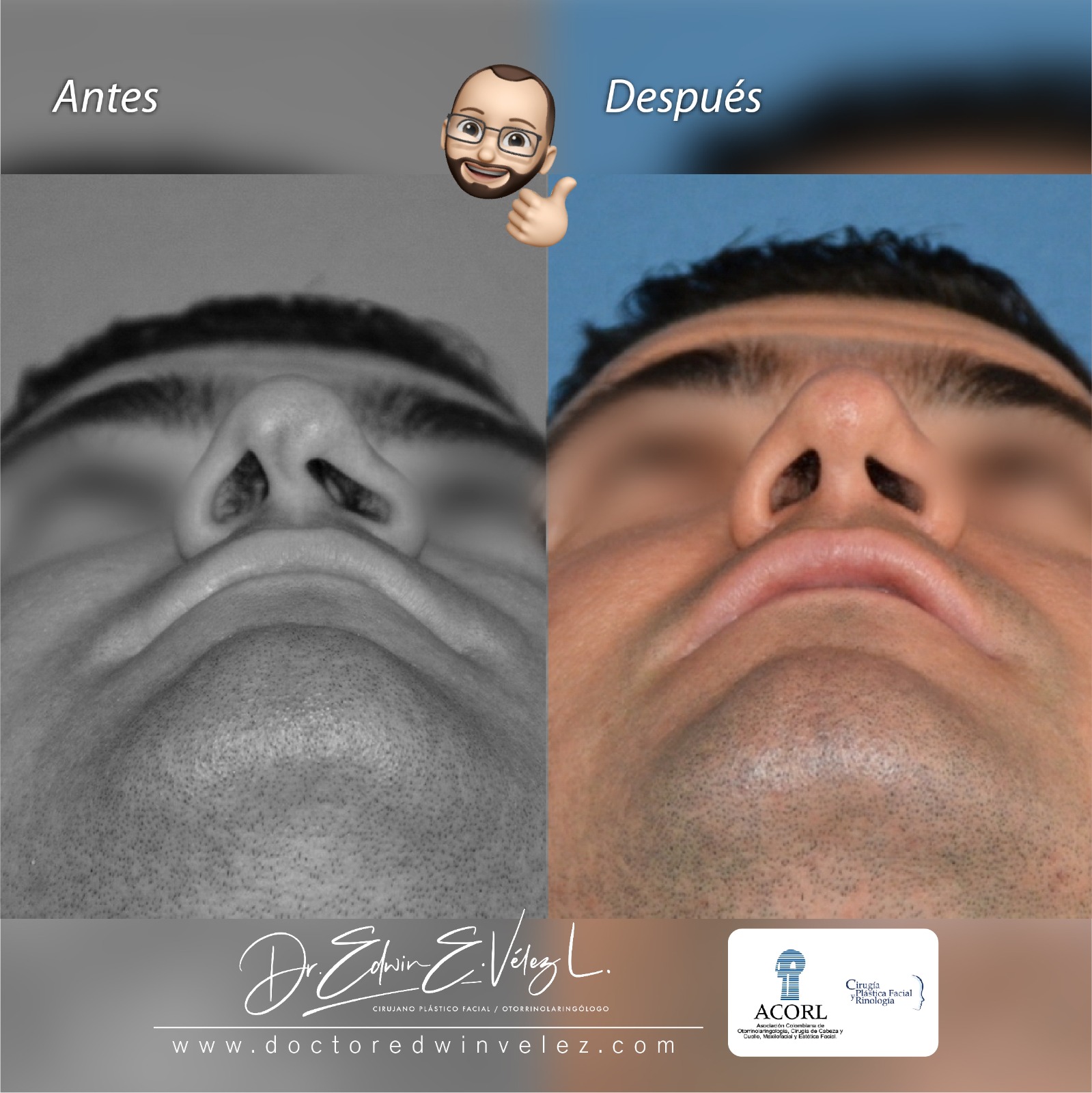 Rinoplastias en Pereira - Antes y después - Doctor Edwin Vélez