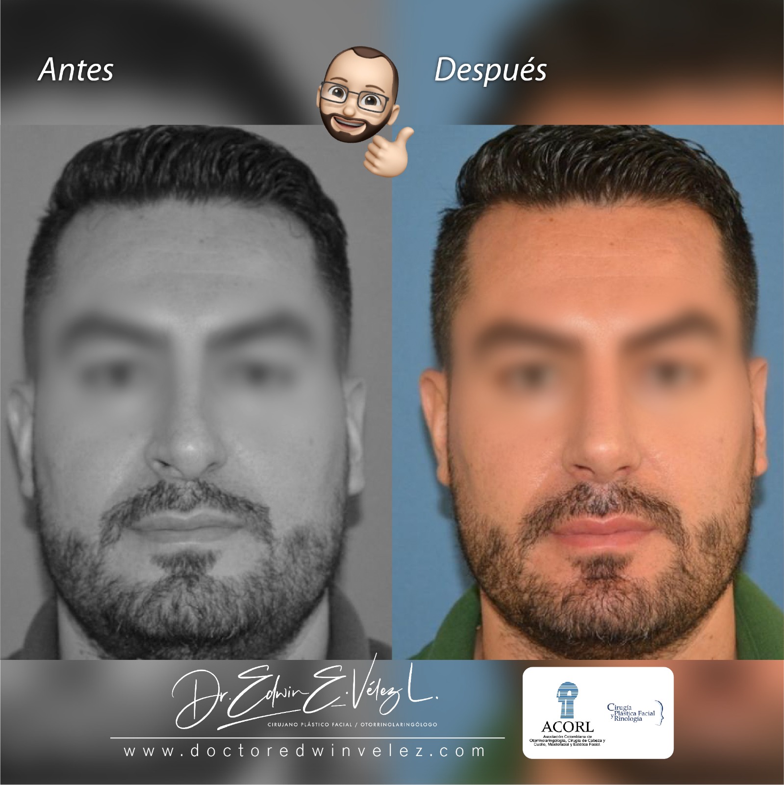 Rinoplastias en Pereira - Antes y después - Doctor Edwin Vélez