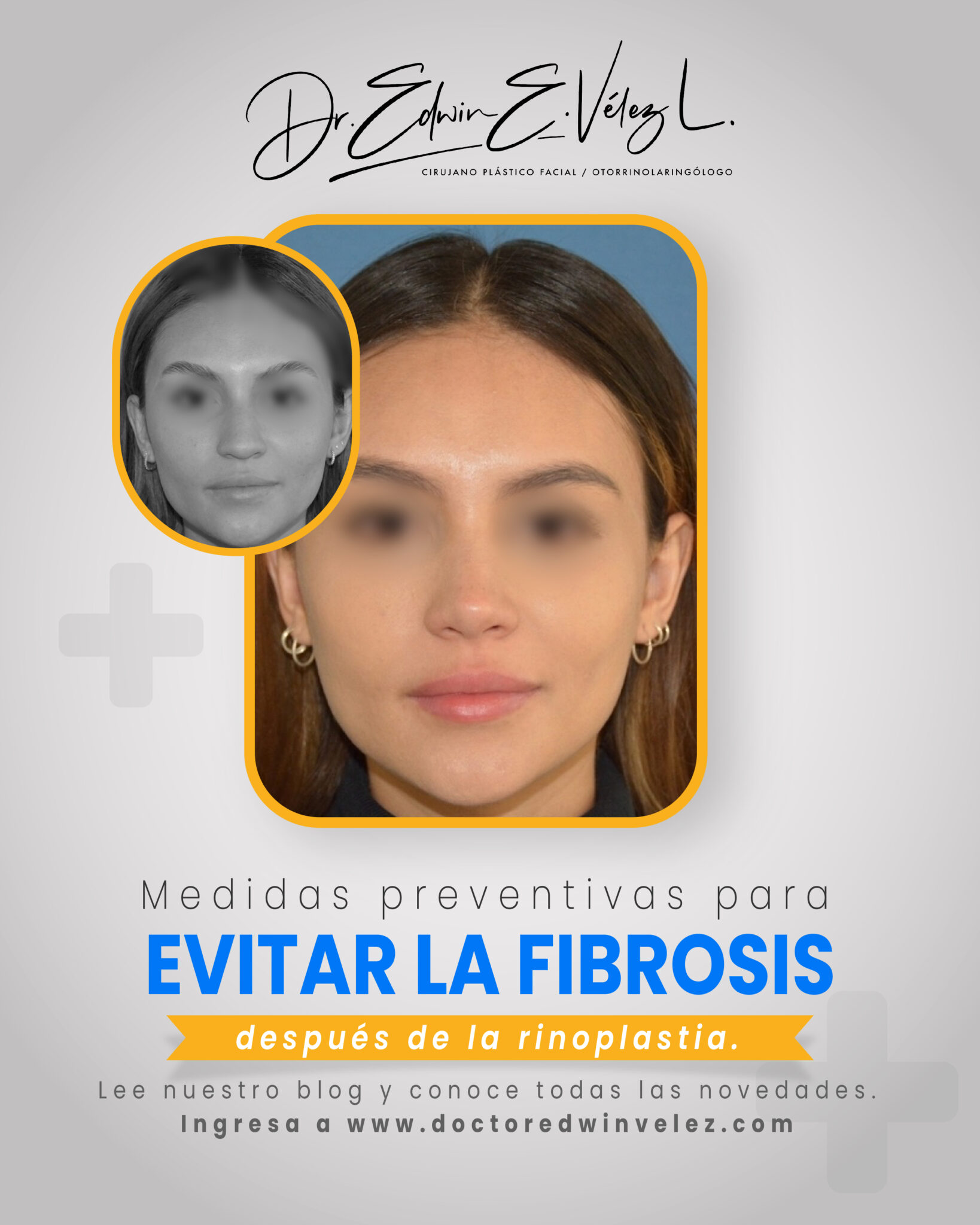Medidas preventivas para evitar la fibrosis después de la rinoplastia ...